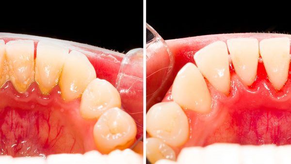 Was ist Zahnstein? Alles, was Sie darüber wissen müssen